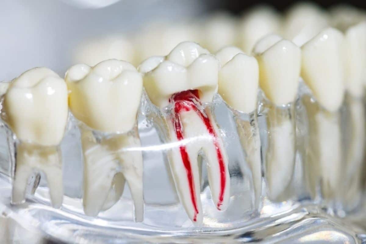 Is A Root Canal Safe? Pain-Free Treatment Procedure